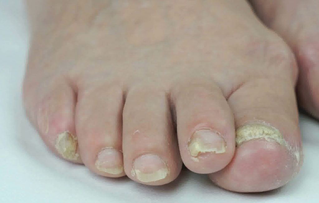 Onychomycosis Of The Feet ICD 10 Code Podiatry Coding