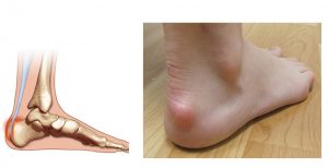 How to code surgical removal of a Haglund's deformity - Podiatry Coding